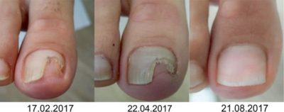 ONYGEN® Krem, skuteczny krem na onycholizę, 20ml – Gabinet Podologiczny ...